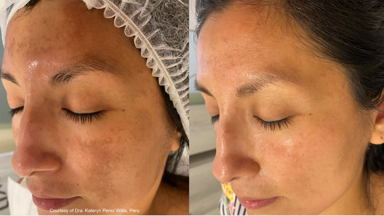 Tixel Laser | Cheung Aesthetics & Wellness